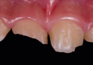 Guidelines – International Association of Dental Traumatology
