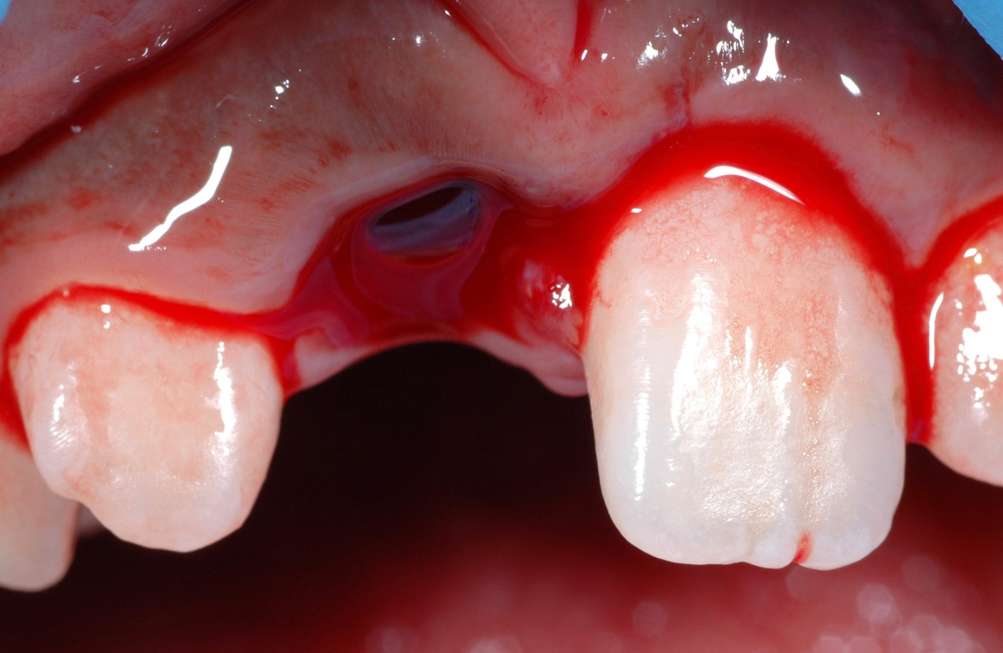 Knocked out – International Association of Dental Traumatology