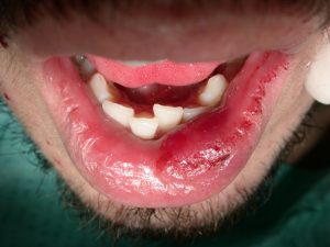 Lip and Soft Tissue Lacerations – International Association of Dental ...