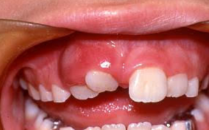 Pushed In – International Association of Dental Traumatology